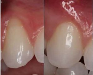 Connective Tissue Grafting in Reno, NV | Sierra Nevada Periodontics and ...