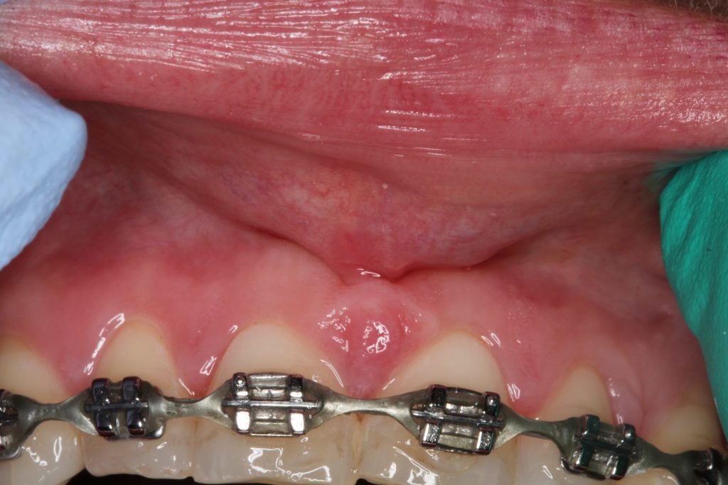 Frenectomies in Reno, NV | Sierra Nevada Periodontics and Implant Dentistry